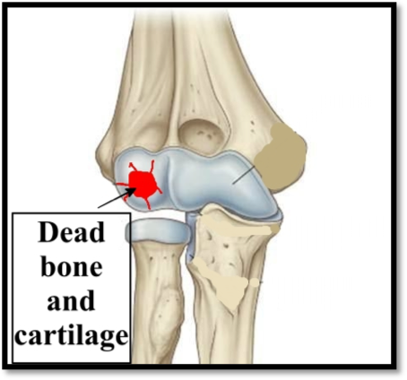 Best Elbow Surgeon in Surat | Elbow Treatments in Surat