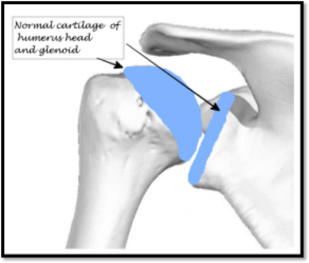 Best Shoulder replacement surgeon | Shoulder arthroscopy doctor in Surat
